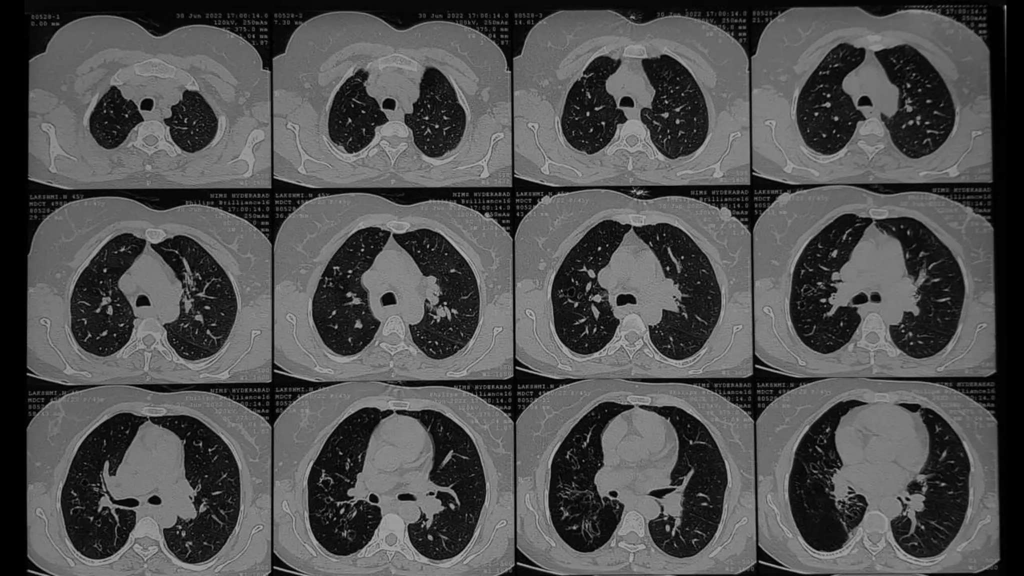 8th july chest rad indexed.pptx