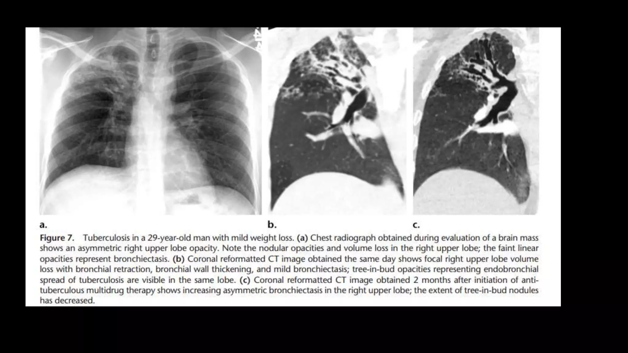 8th july chest rad indexed.pptx