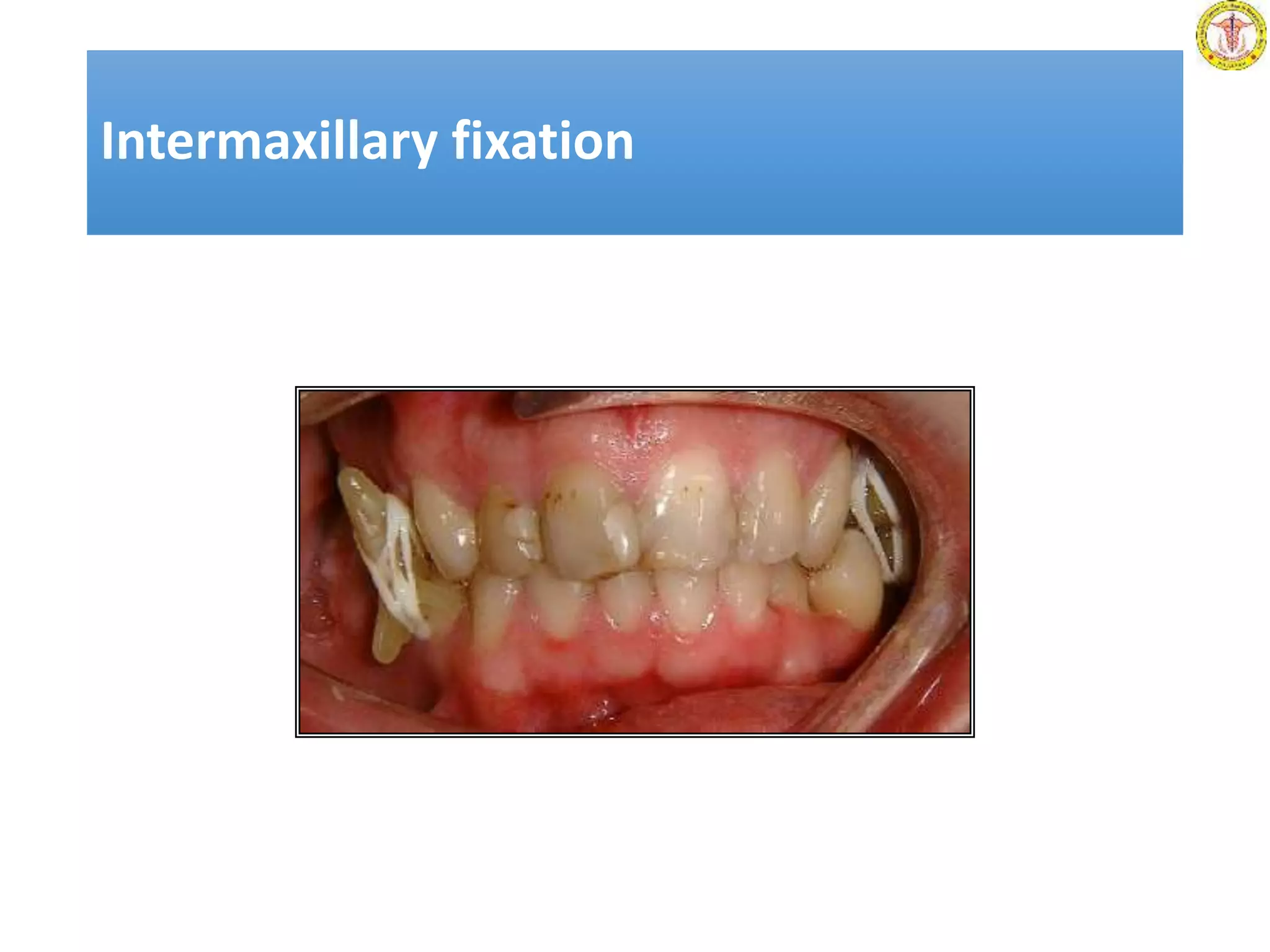 Temporomandibular joint dislocation | PPTX