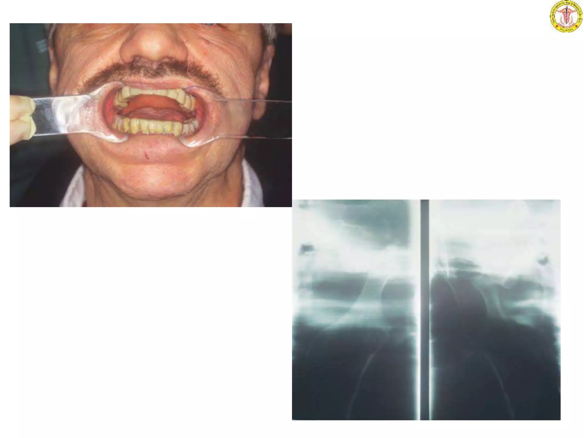 Temporomandibular Joint Dislocation Pptx