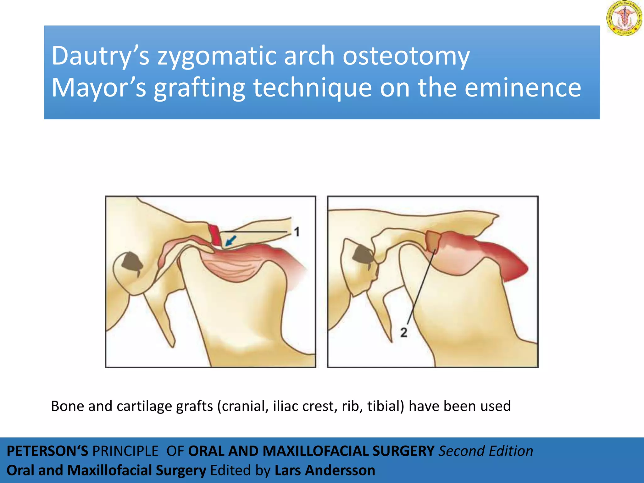 Temporomandibular Joint Dislocation Pptx