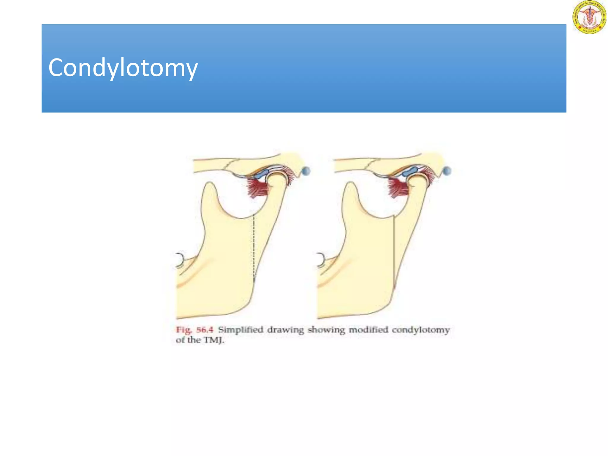 Temporomandibular Joint Dislocation Pptx