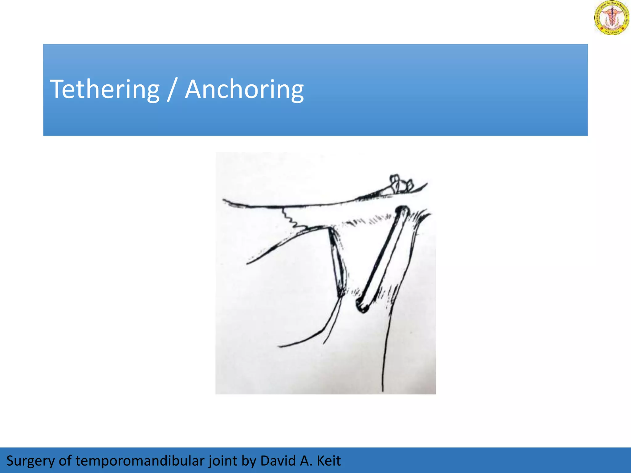 Temporomandibular Joint Dislocation Ppt