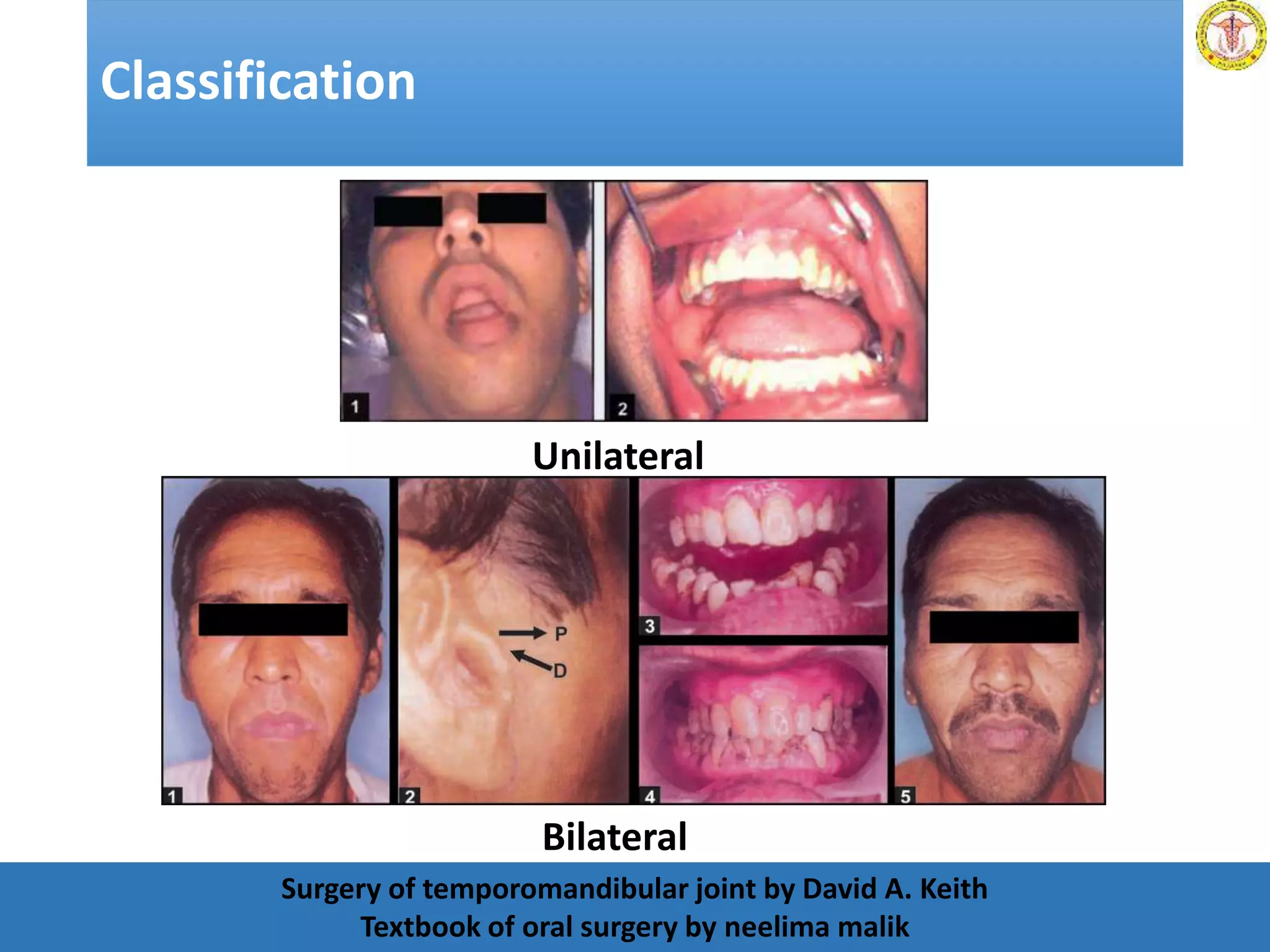 Temporomandibular Joint Dislocation Pptx