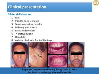 Temporomandibular joint dislocation | PPTX