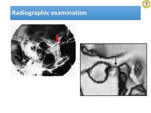 Temporomandibular joint dislocation | PPTX