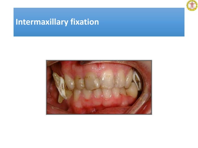Temporomandibular Joint Dislocation Pptx