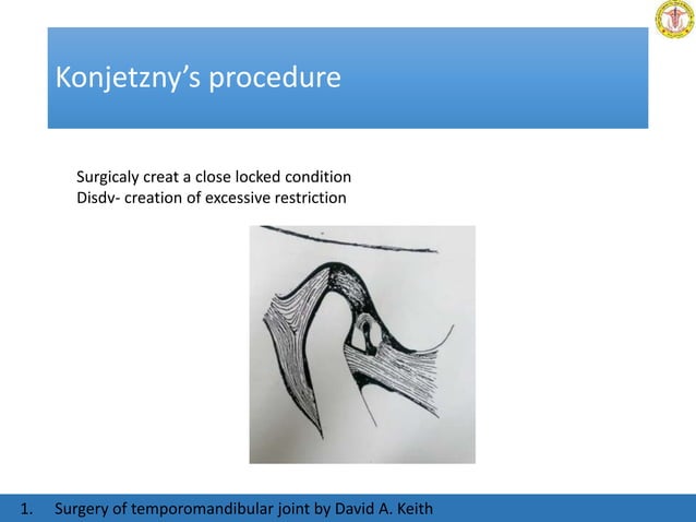 Temporomandibular Joint Dislocation Pptx