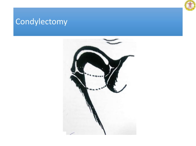 Temporomandibular joint dislocation | PPTX