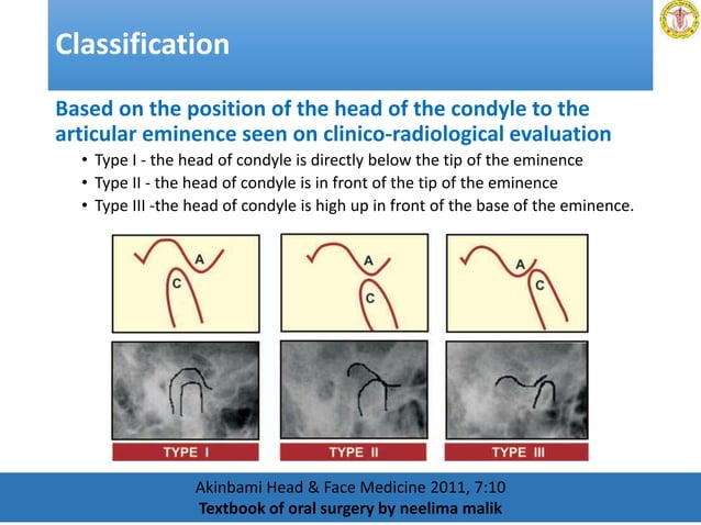 Temporomandibular joint dislocation | PPTX