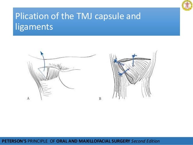 Temporomandibular joint dislocation