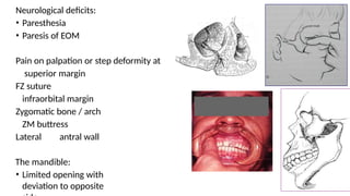 8zygomaticomaxillarycomplexfractures-220403140435.pptx