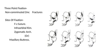 8zygomaticomaxillarycomplexfractures-220403140435.pptx
