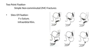 8zygomaticomaxillarycomplexfractures-220403140435.pptx