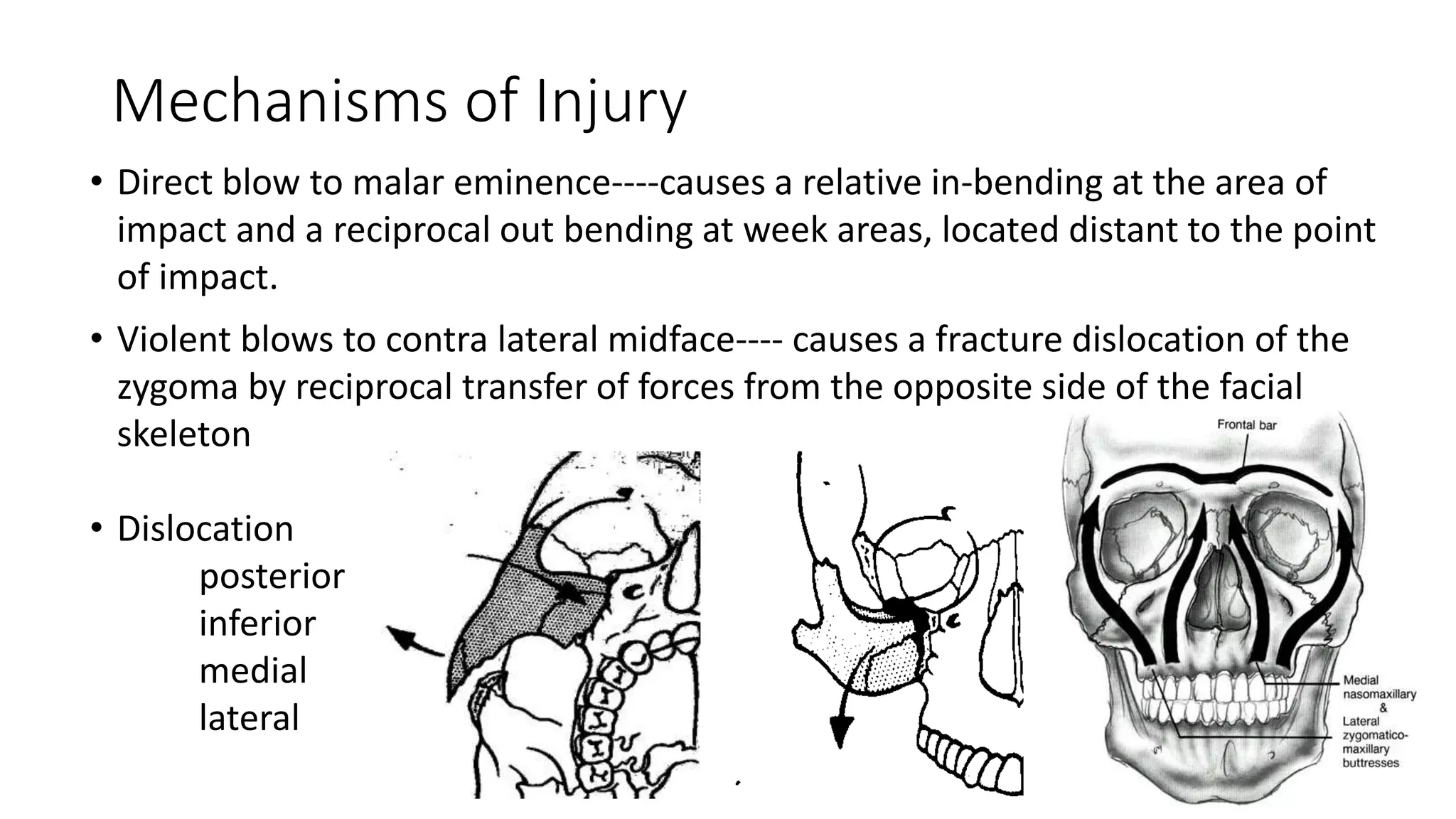 Zygomatico Maxillary Complex Fractures.pptx | Death, Injury, or ...