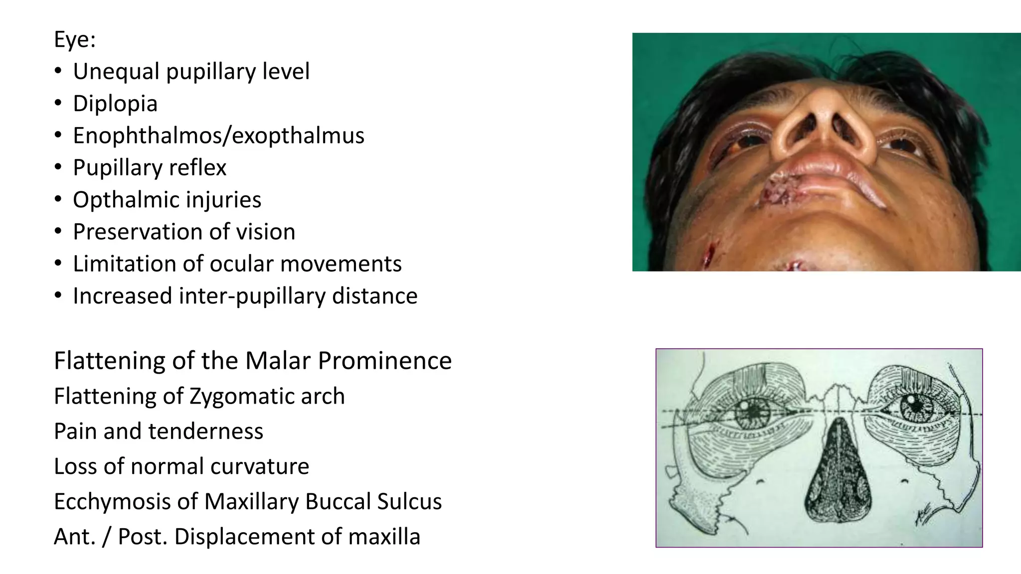 Zygomatico Maxillary Complex Fractures.pptx