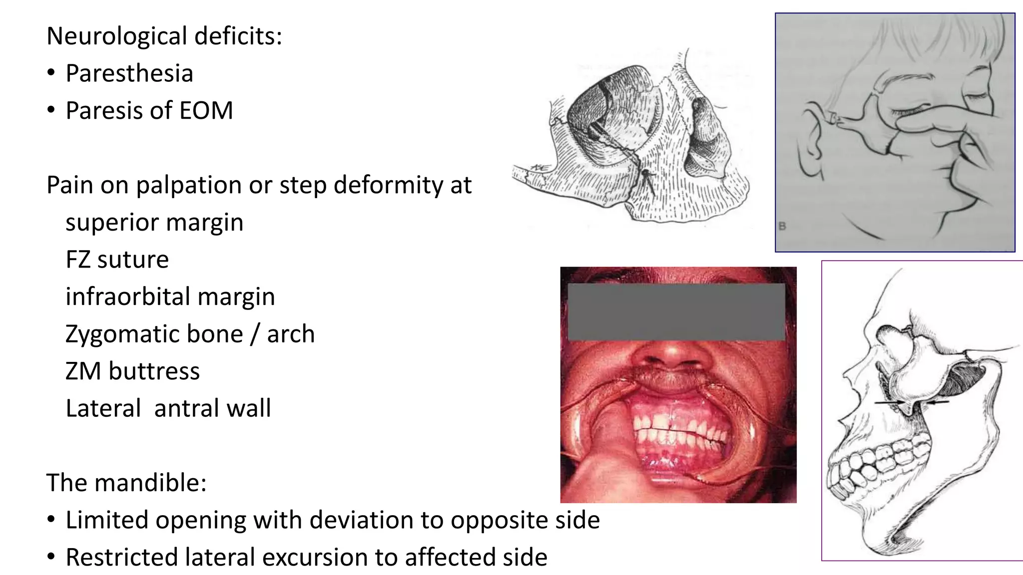 Zygomatico Maxillary Complex Fractures.pptx