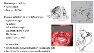 Zygomatico Maxillary Complex Fractures.pptx