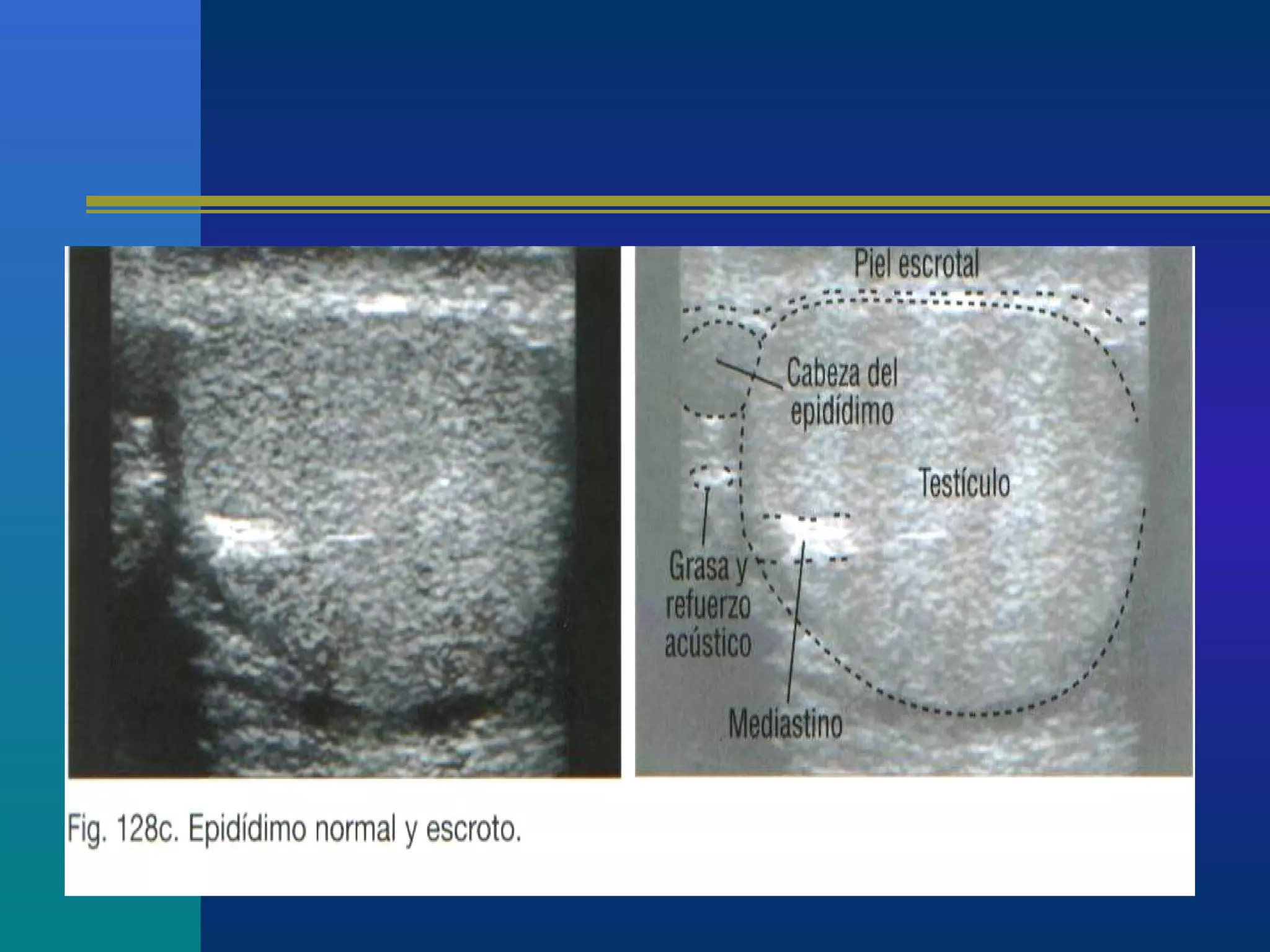 9. ecografia de testiculo y escroto