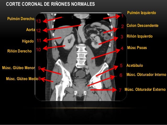 Clase de Riñon - TC