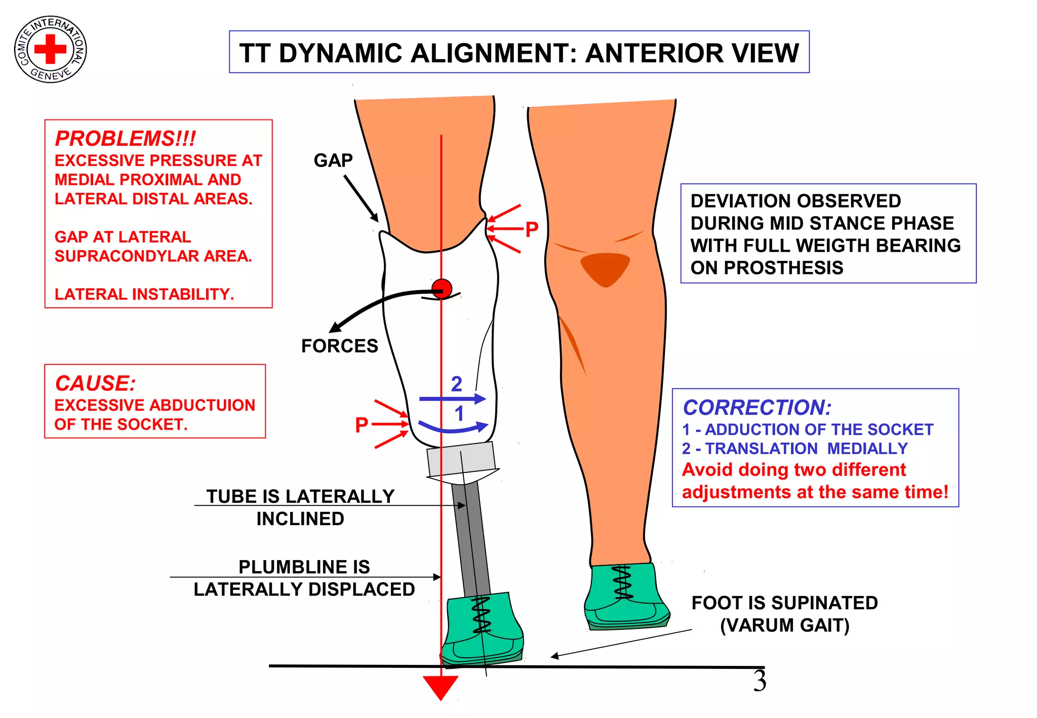 Transtibial Dynamic Alignment | PPT