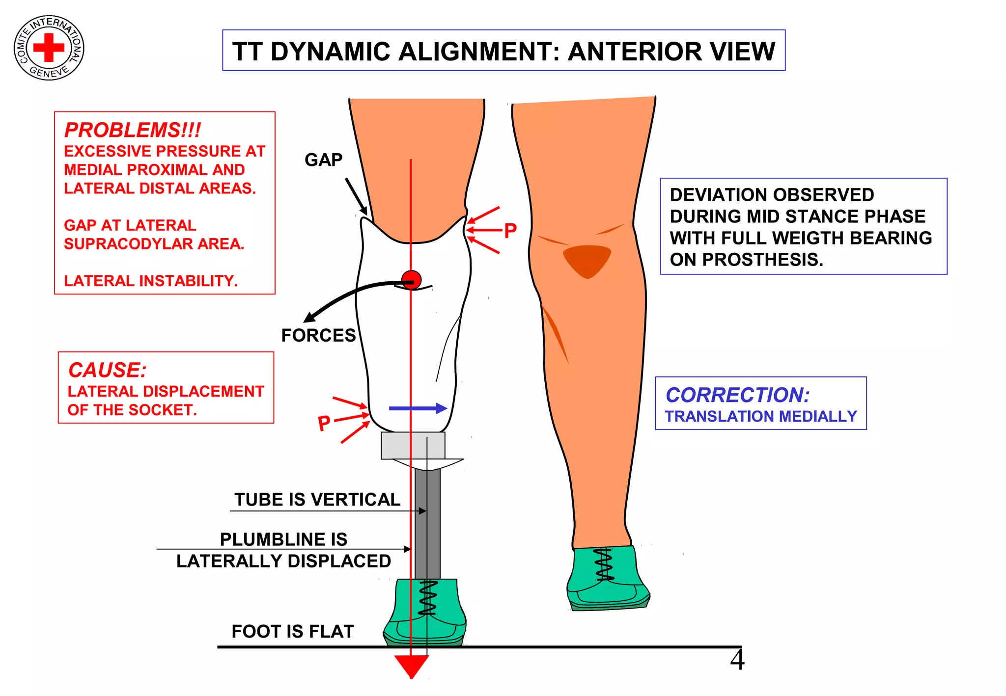 Transtibial Dynamic Alignment Ppt