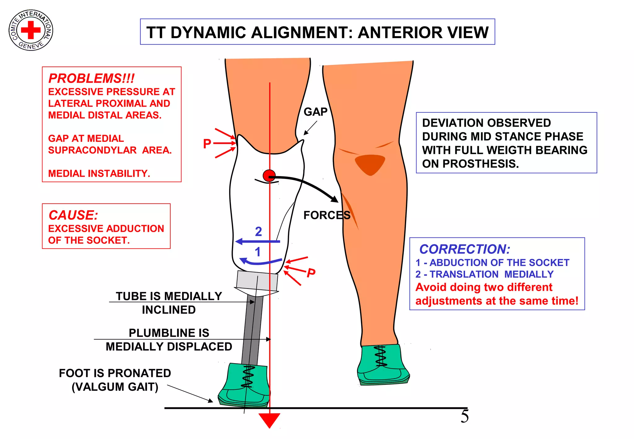 Transtibial Dynamic Alignment | PPT | Death, Injury, or Military ...
