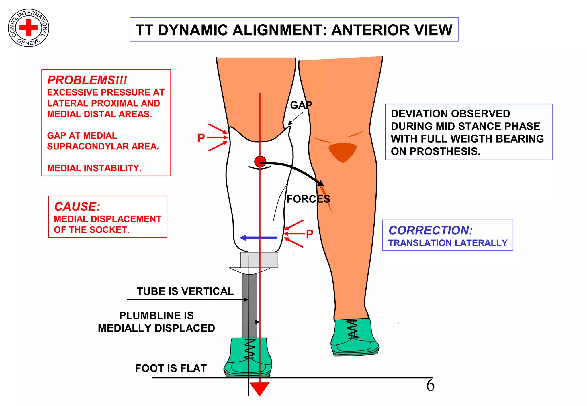 Transtibial Dynamic Alignment | PPT
