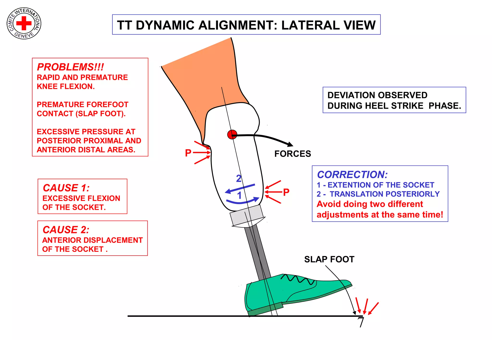 Transtibial Dynamic Alignment | PPT