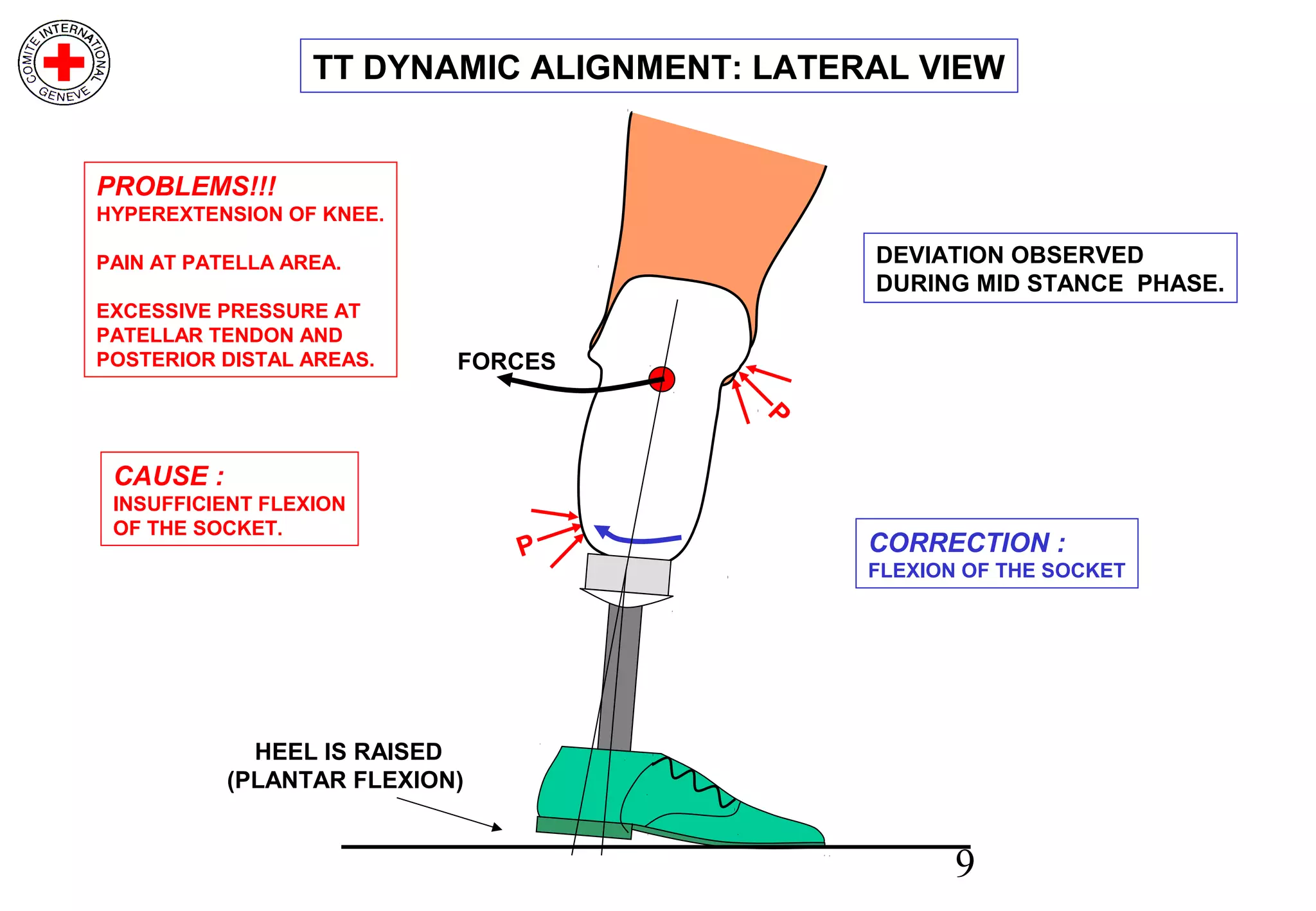 Transtibial Dynamic Alignment | PPT