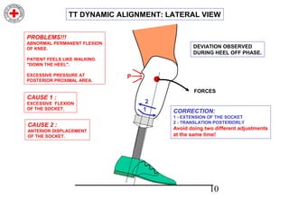 Transtibial Dynamic Alignment | PPT