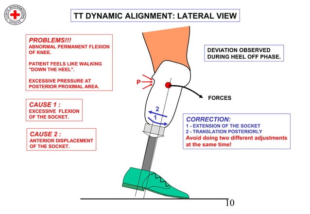 Transtibial Dynamic Alignment | PPT | Death, Injury, or Military ...