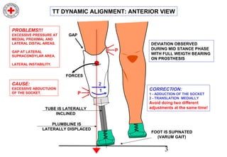 Transtibial Dynamic Alignment | PPT