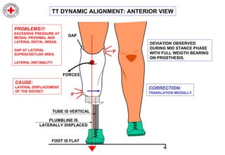 Transtibial Dynamic Alignment | PPT