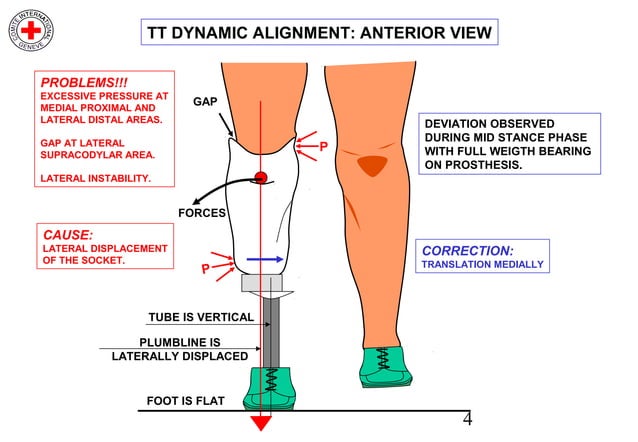 Transtibial Dynamic Alignment | PPT | Death, Injury, or Military ...