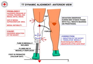 Transtibial Dynamic Alignment | PPT