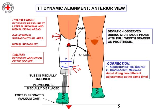 Transtibial Dynamic Alignment | PPT | Death, Injury, or Military ...