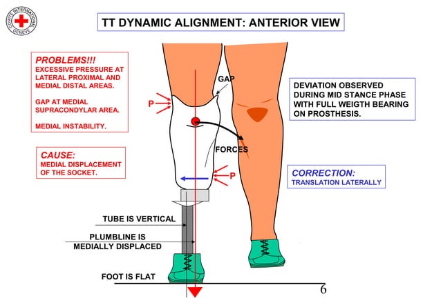Transtibial Dynamic Alignment | PPT | Death, Injury, or Military Conflict | Sensitive Topics