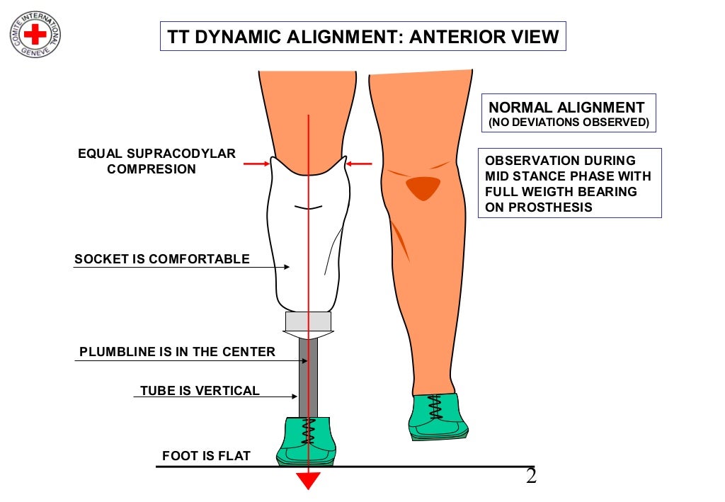 Transtibial Dynamic Alignment