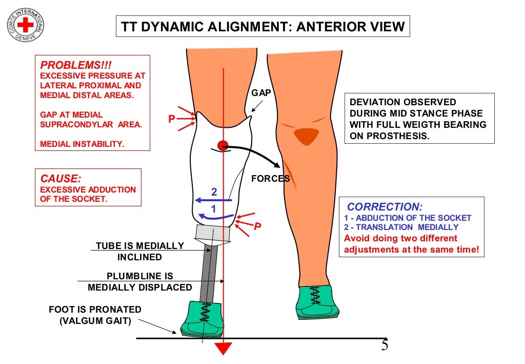 Transtibial Dynamic Alignment