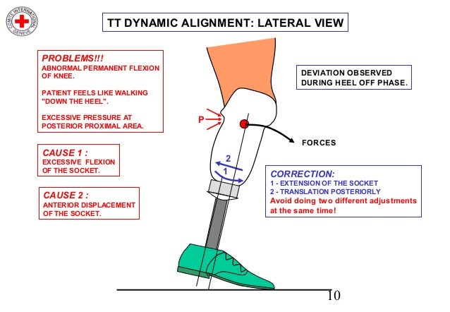Transtibial Dynamic Alignment