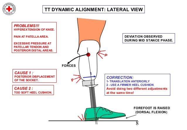 Transtibial Dynamic Alignment