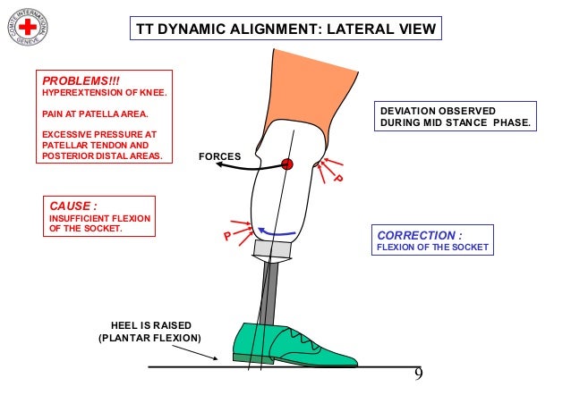 Transtibial Dynamic Alignment