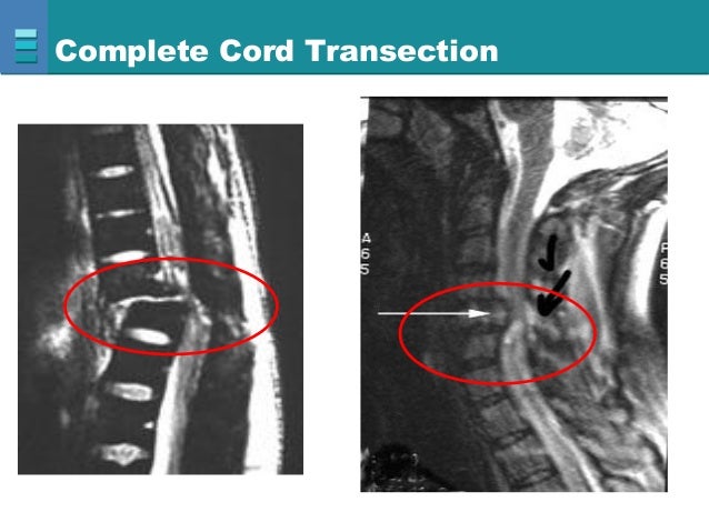 9.transection of sc kjg
