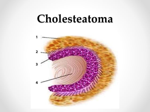 Cholesteatoma | PPTX | Ear, Nose and Throat Conditions | Diseases and ...