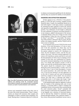 early orthodonatic treatment - serial extraction revisited | PDF