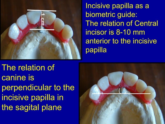 9. anterior teeth arrangement | PPT | Dental Health | Diseases and ...