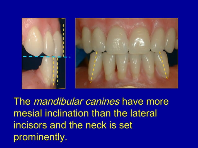 9. anterior teeth arrangement | PPT | Dental Health | Diseases and ...