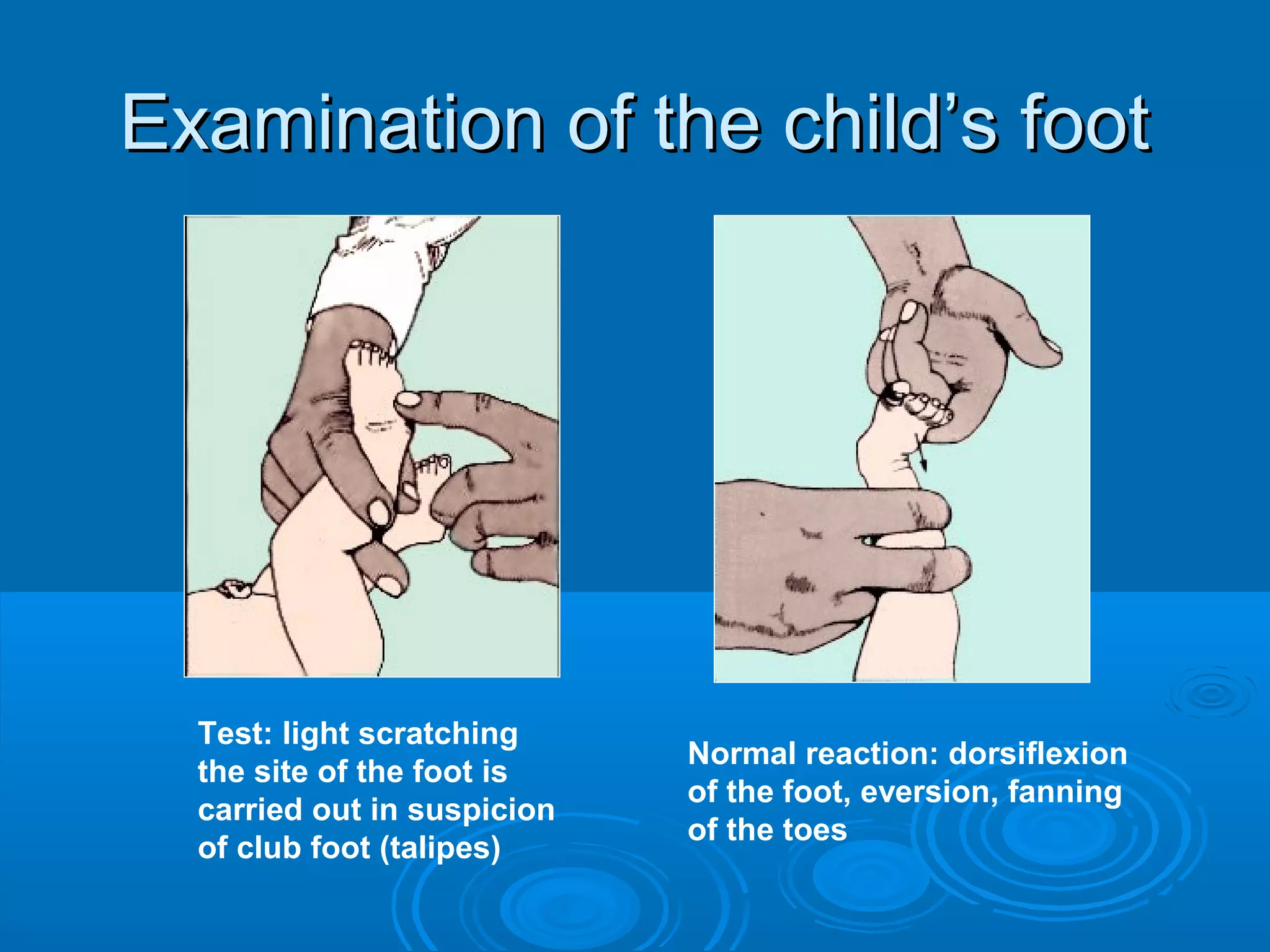 Deformities of the Foot | PPT