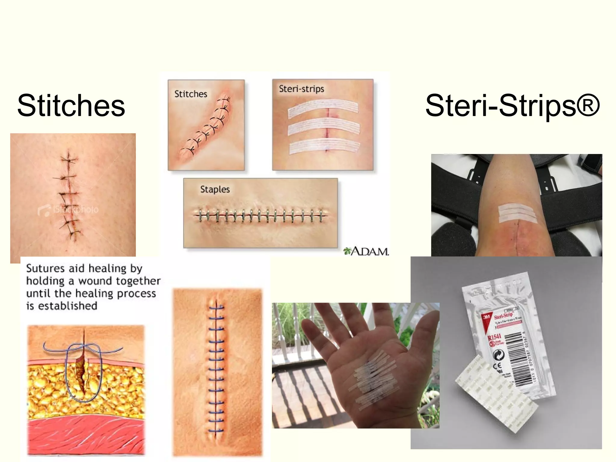 Skin wounds. Classification | PPT